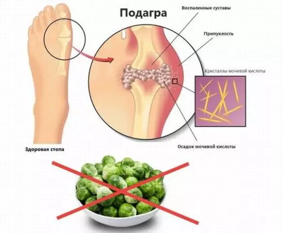 Брусэльская капуста: хімічны склад, карысць і шкоду, супрацьпаказанні, правілы ўжывання 12092_6