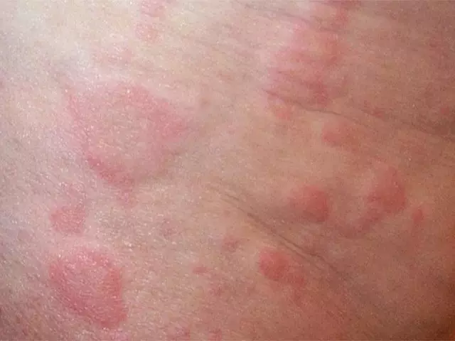 Alergia la pepene galben: simptome, cauze, tratament la adulți, la copii 164_2