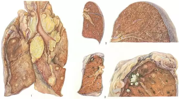 Tuberkulosis pada lembu: batuk kering, gejala, rawatan, pencegahan 3756_5